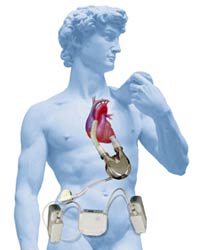 Batte in un paziente tedesco il primo cuore artificiale italiano ...